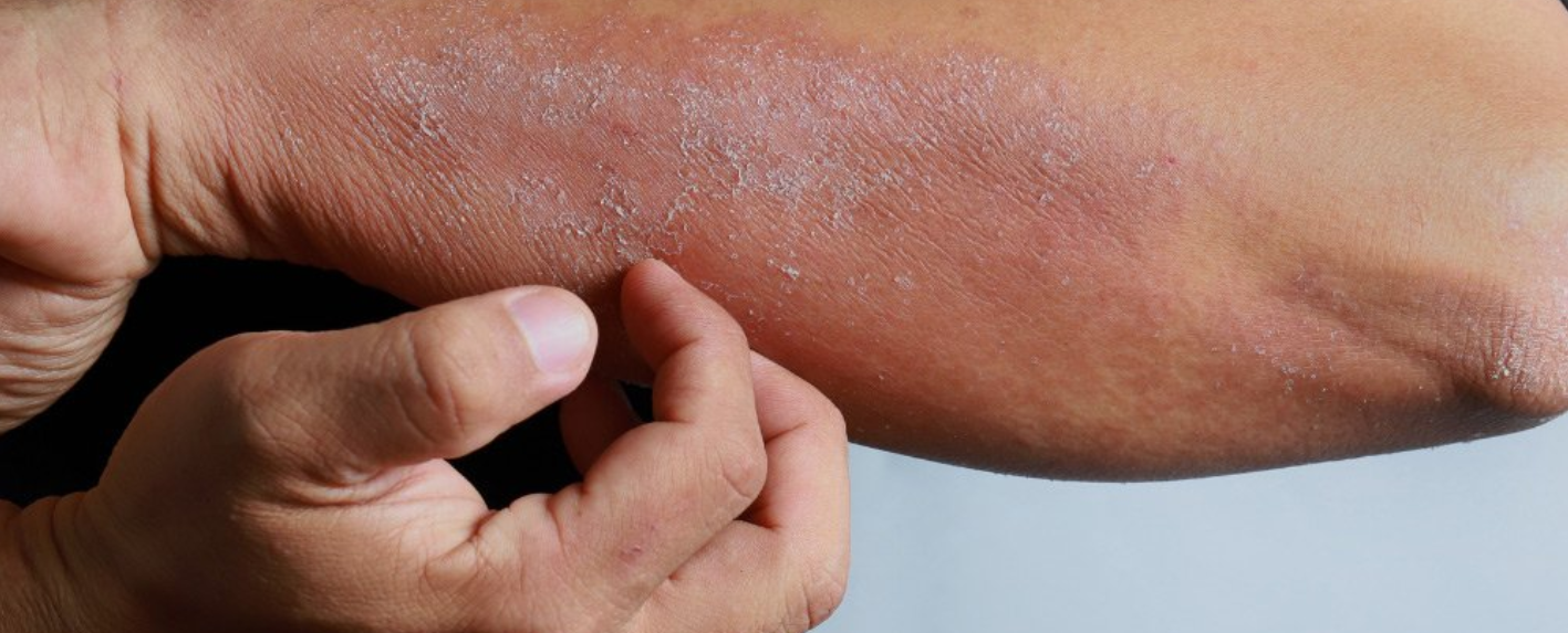 Atopická dermatitída č.2 | Najlekáreň.eu