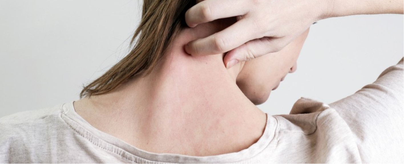 Psoriáza. Ako si s ňou poradiť? | Najlekáreň.eu