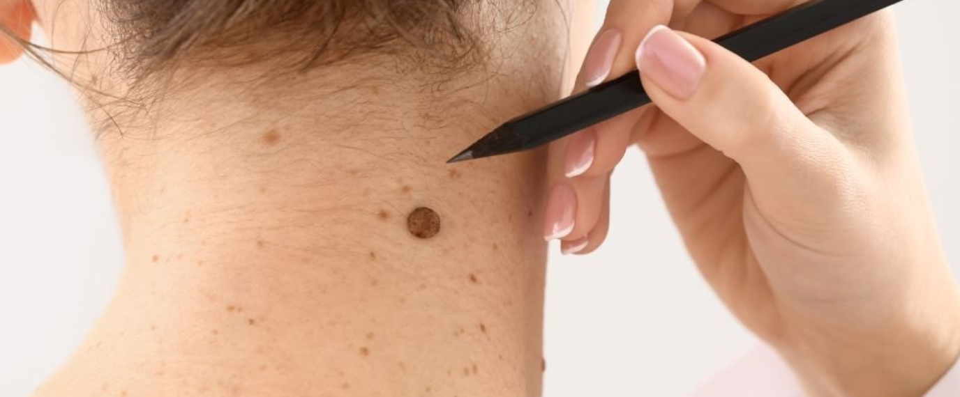 Nebezpečná rakovina kože. Ako sa chrániť? | Najlekáreň.eu